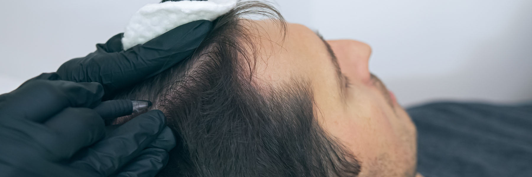 SMP Art and Science: Understanding Scalp Micropigmentation — Industry ...